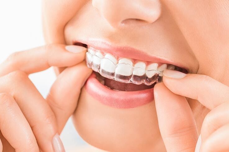 How to Deal With Invisalign Pain: 10 Dentist-Approved Tips