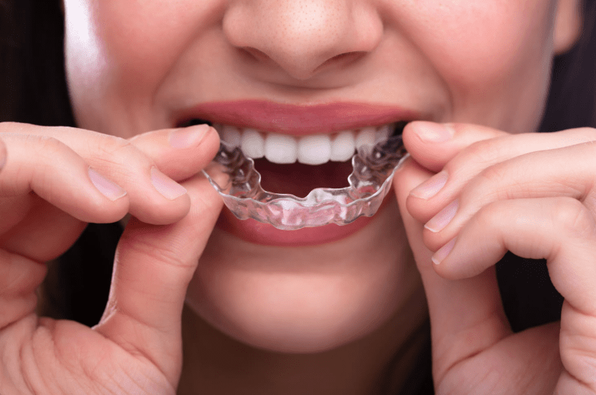 How Do I Know When to Change My Invisalign Trays? A Guide